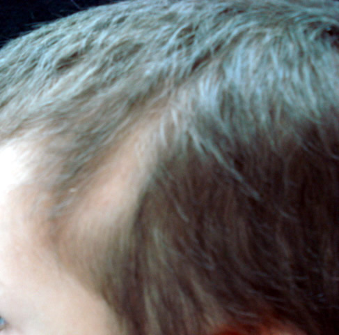 245 – Consulta a un Colega Nº 6: Alopecias triangular temporal desde el ...