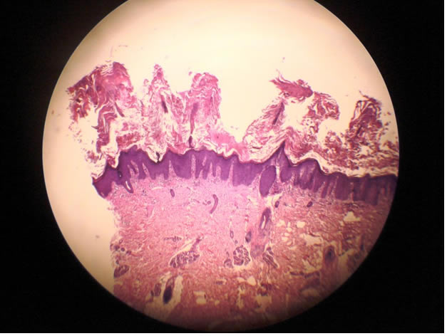 246 – Consulta a un Colega Nº 4: ¿Genodermatosis? – PIEL-L Latinoamericana