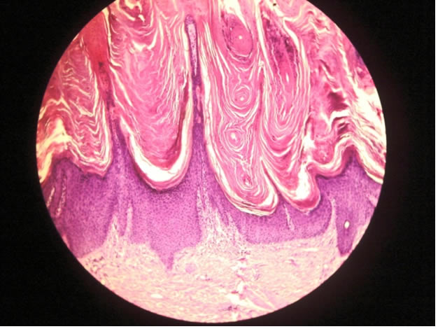246 – Consulta a un Colega Nº 4: ¿Genodermatosis? – PIEL-L Latinoamericana