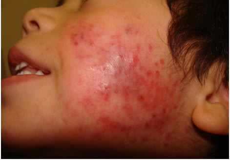 249 – Consulta a un Colega Nº 4: Dermatosis localizada en cara ...