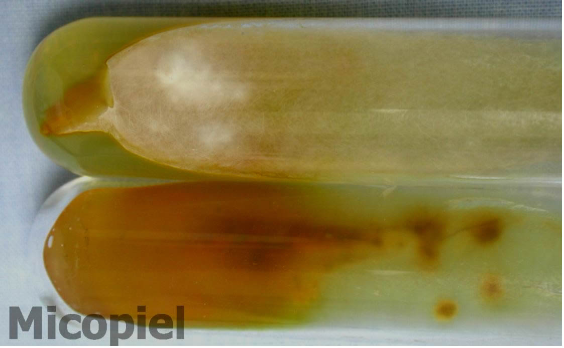 Caso clínico Nº 40. Placas alopécicas en cuero cabelludo. – PIEL-L ...