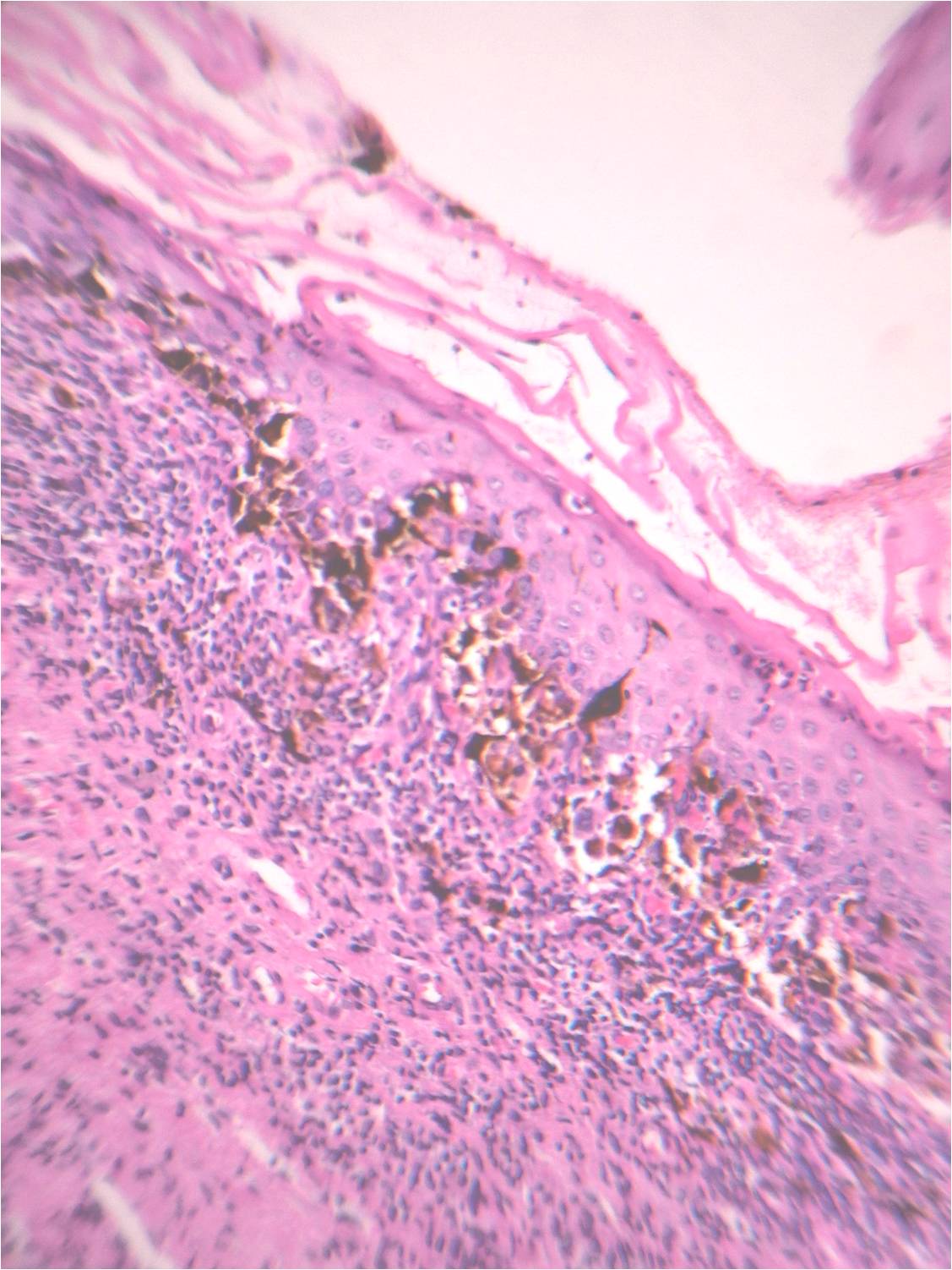 254 – Consulta a un Colega Nº1: Melanoma de la vulva – PIEL-L ...