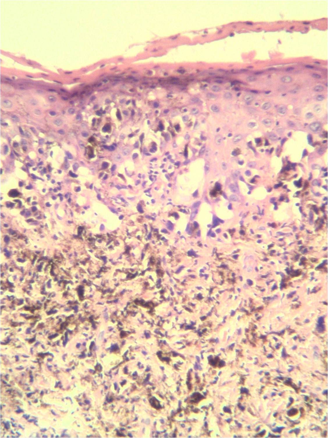 254 – Consulta a un Colega Nº1: Melanoma de la vulva – PIEL-L ...