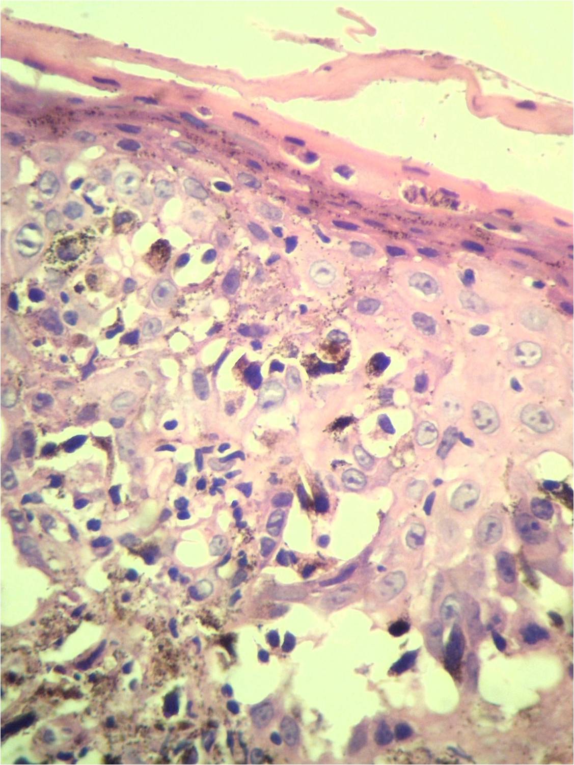 254 – Consulta a un Colega Nº1: Melanoma de la vulva – PIEL-L ...