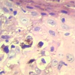 254 – Consulta a un Colega Nº1: Melanoma de la vulva – PIEL-L ...