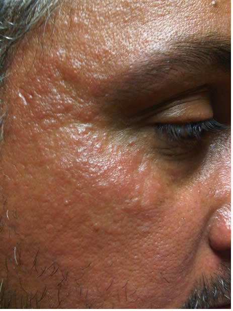 Dermatosis localizada en áreas expuestas caracterizada por eritema ...