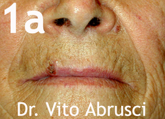 COMO LO HAGO: Lesiòn nodulo-ulcerada del labio superior (Respuesta ...