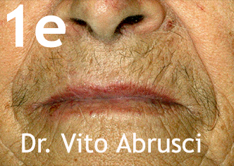 COMO LO HAGO: Lesiòn nodulo-ulcerada del labio superior (Respuesta ...