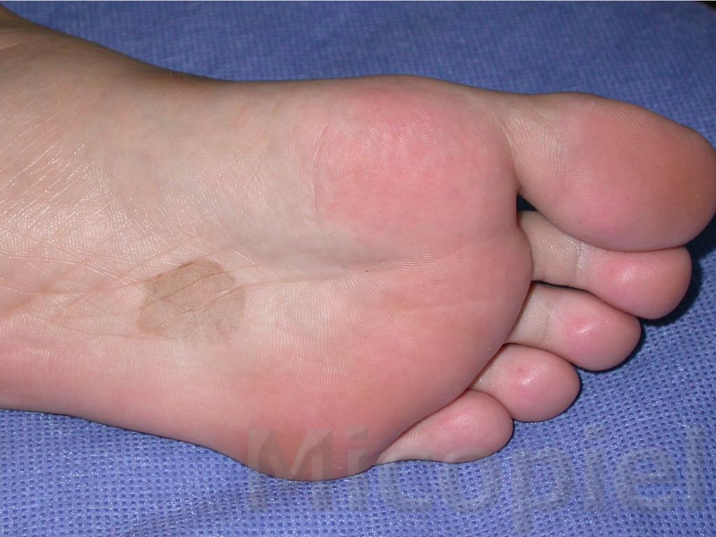 Caso clínico Nº 44. Tinea nigra – PIEL-L Latinoamericana