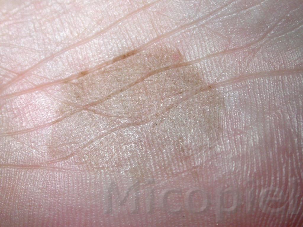 Caso clínico Nº 44. Tinea nigra – PIEL-L Latinoamericana