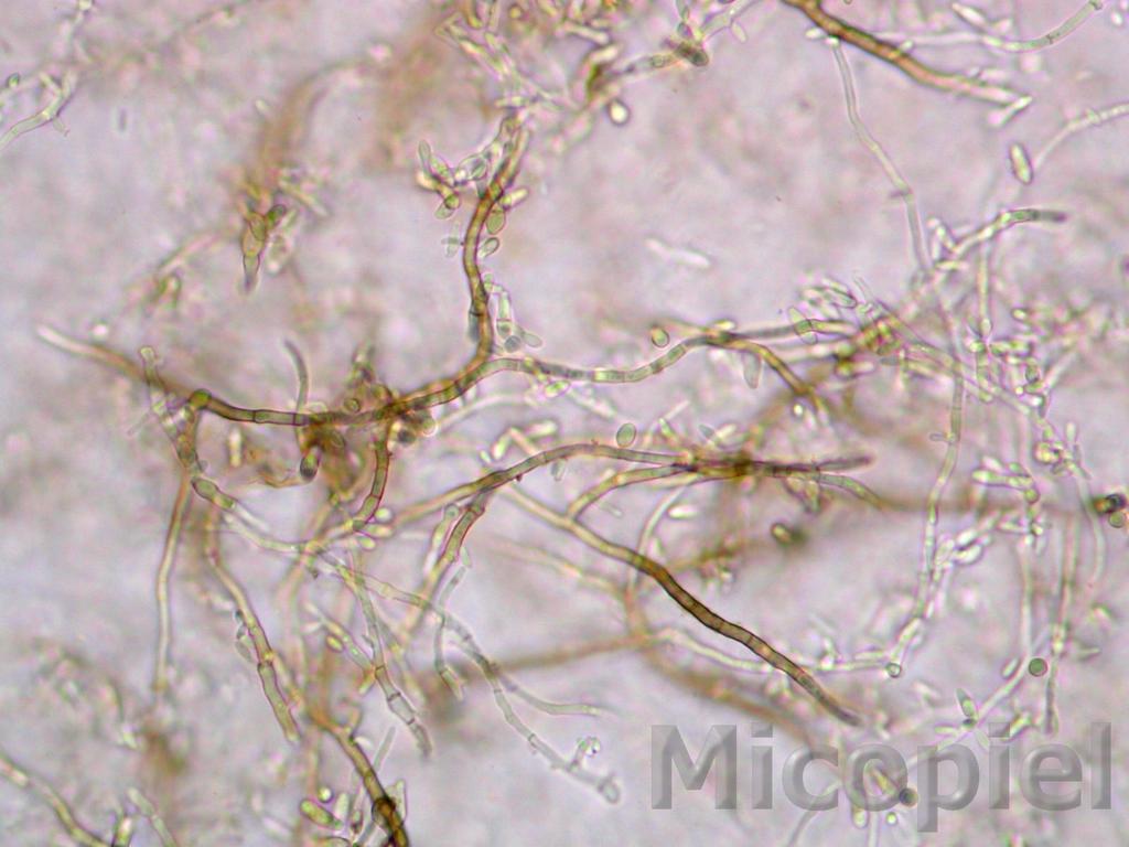 Caso clínico Nº 44. Tinea nigra – PIEL-L Latinoamericana