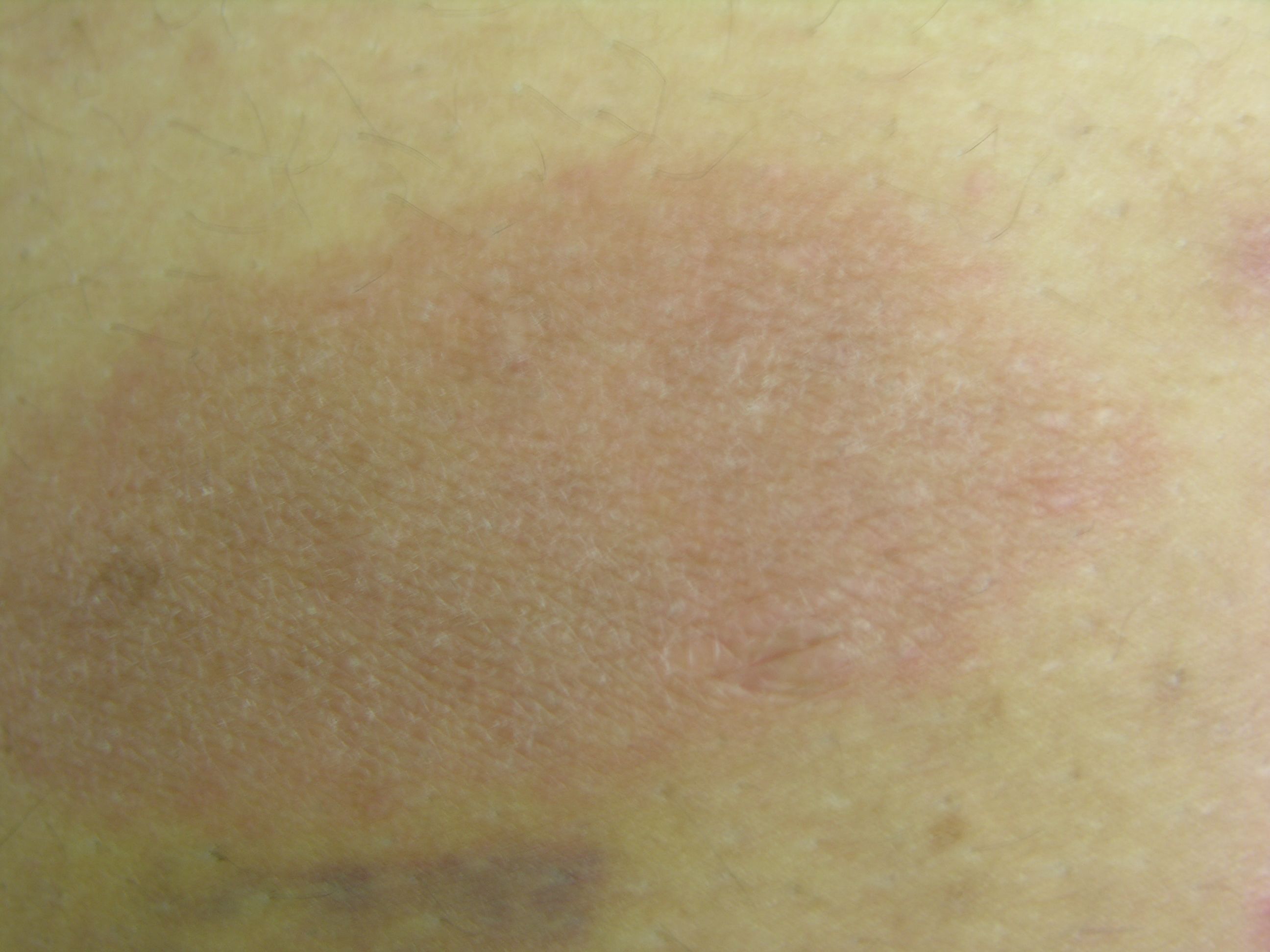 255 – Consulta a un Colega Nº1: Placa eritematosa, localizada en piel ...