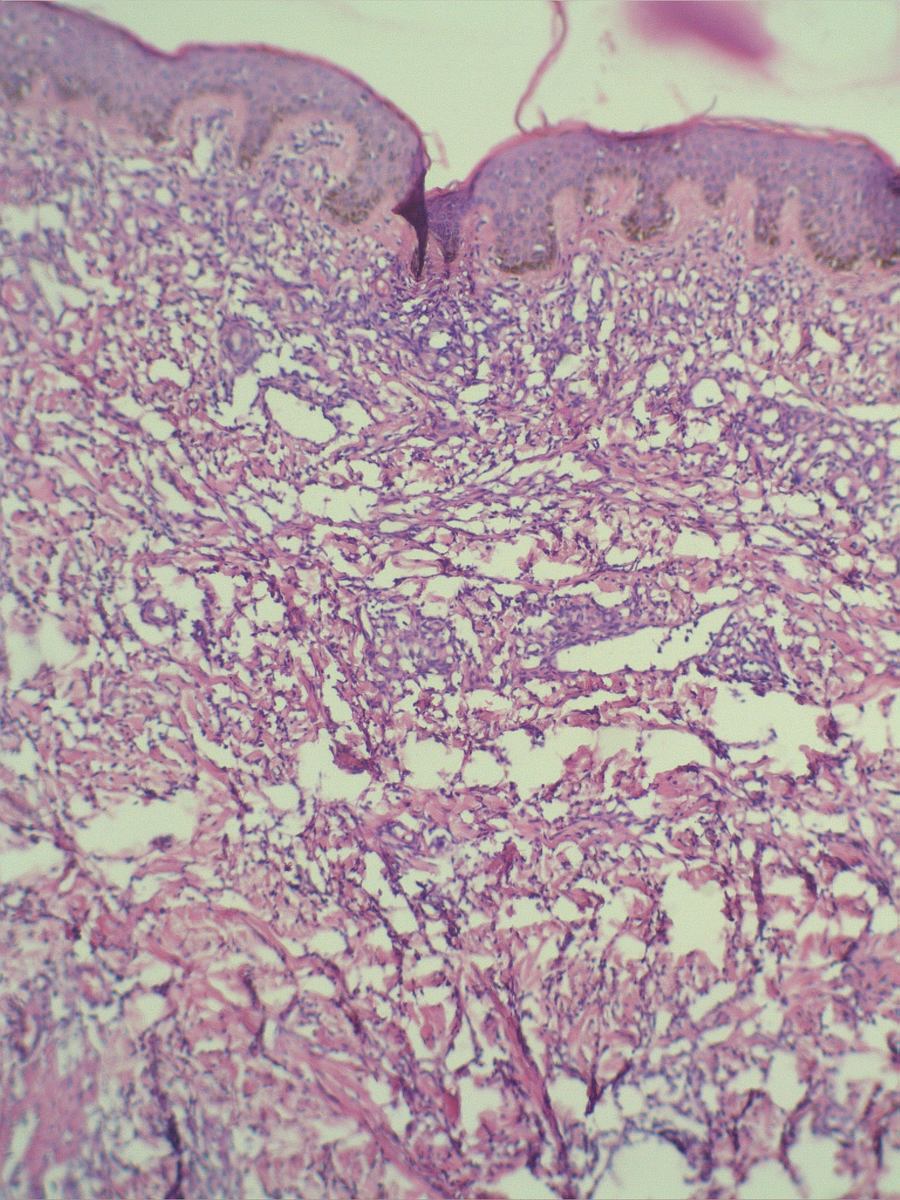 255 – Consulta a un Colega Nº3: Placas y nódulos de diferentes tamaños ...