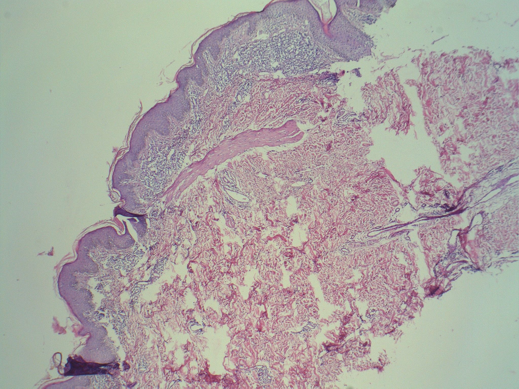 255 – Consulta a un Colega Nº1: Placa eritematosa, localizada en piel ...