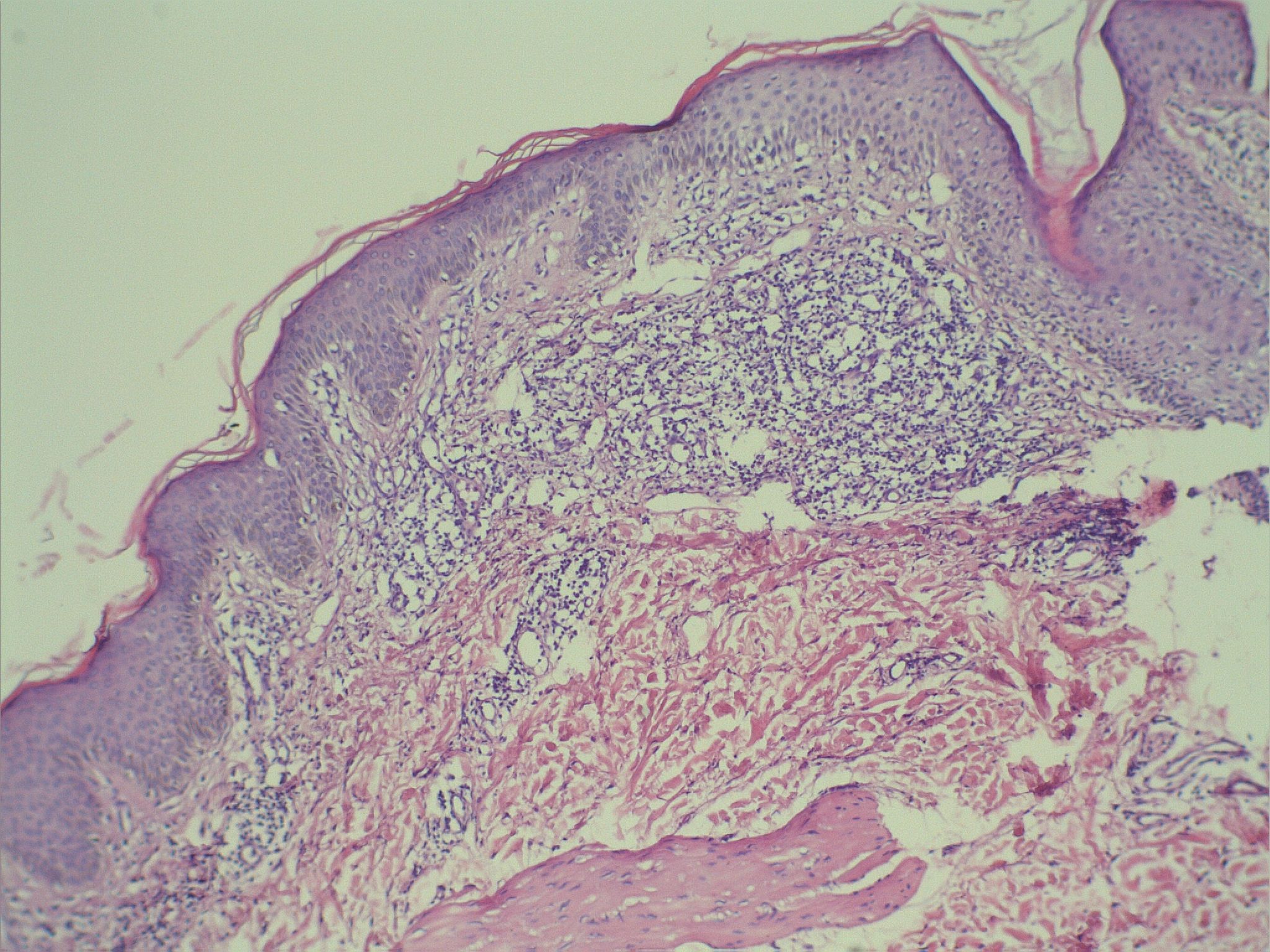 255 – Consulta a un Colega Nº1: Placa eritematosa, localizada en piel ...