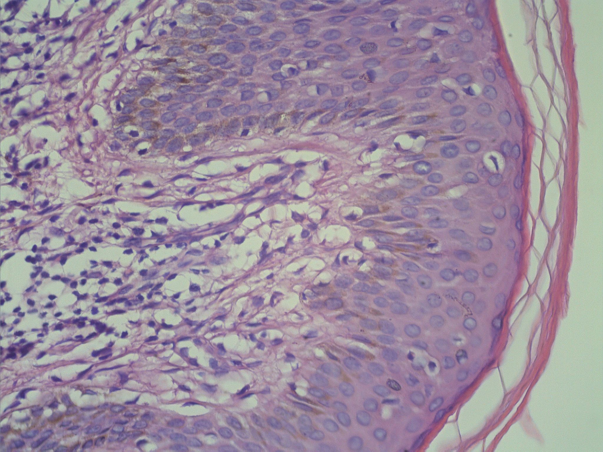 255 – Consulta a un Colega Nº1: Placa eritematosa, localizada en piel ...