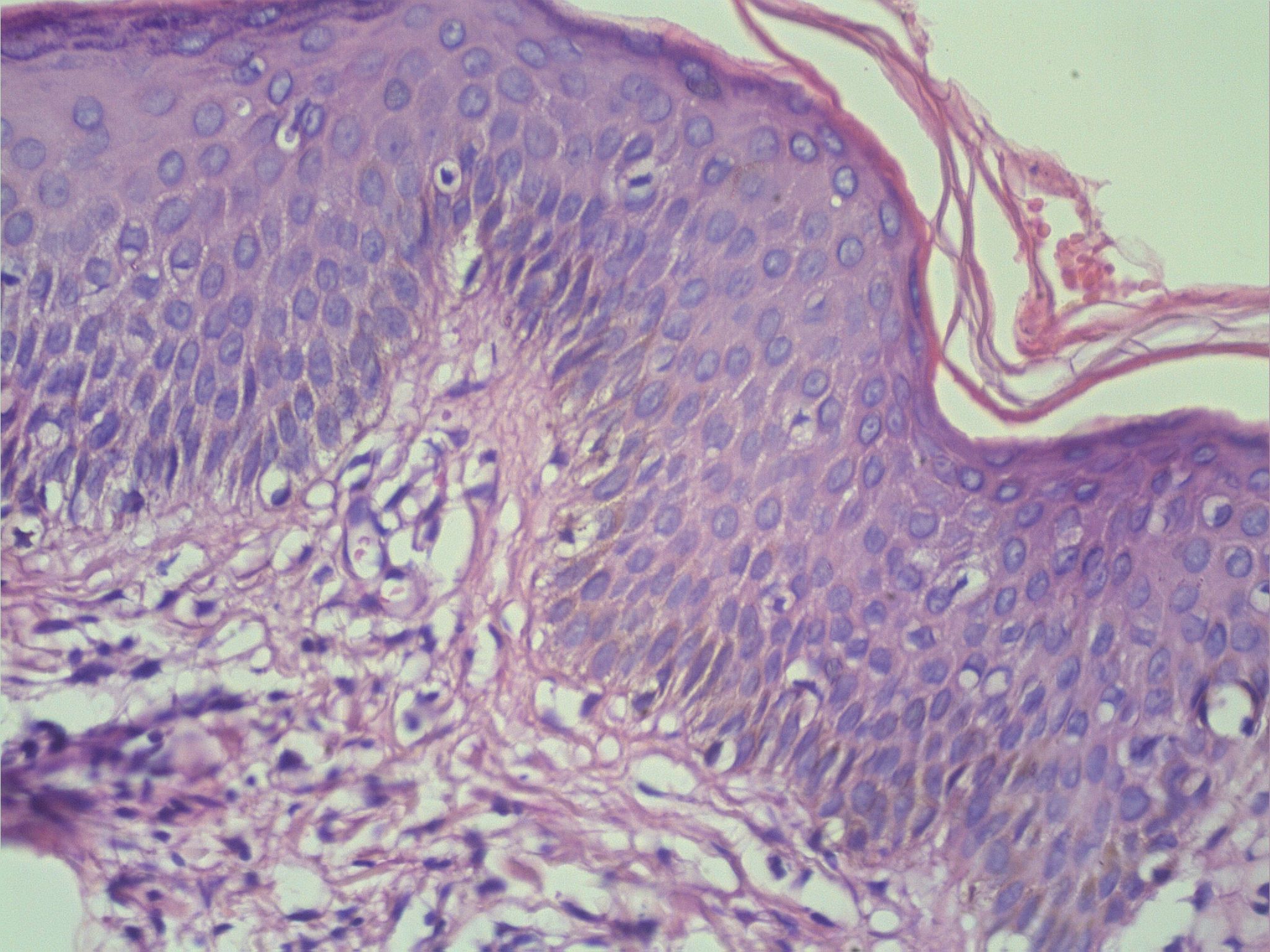 255 – Consulta a un Colega Nº1: Placa eritematosa, localizada en piel ...