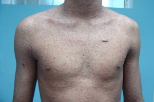 256 – Consulta a un Colega Nº 1: Lesiones tipo papulas eritematosas ...