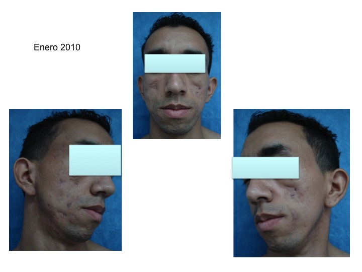 (260) Consulta a un Colega Nº3: Acne nódulo quistico. Reto terapeutico ...