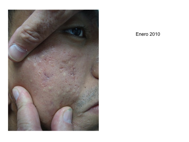 (260) Consulta a un Colega Nº3: Acne nódulo quistico. Reto terapeutico ...