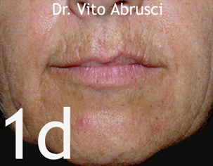 Cicatriz Vertical Del Labio Reparación De Espalda Y Flancos