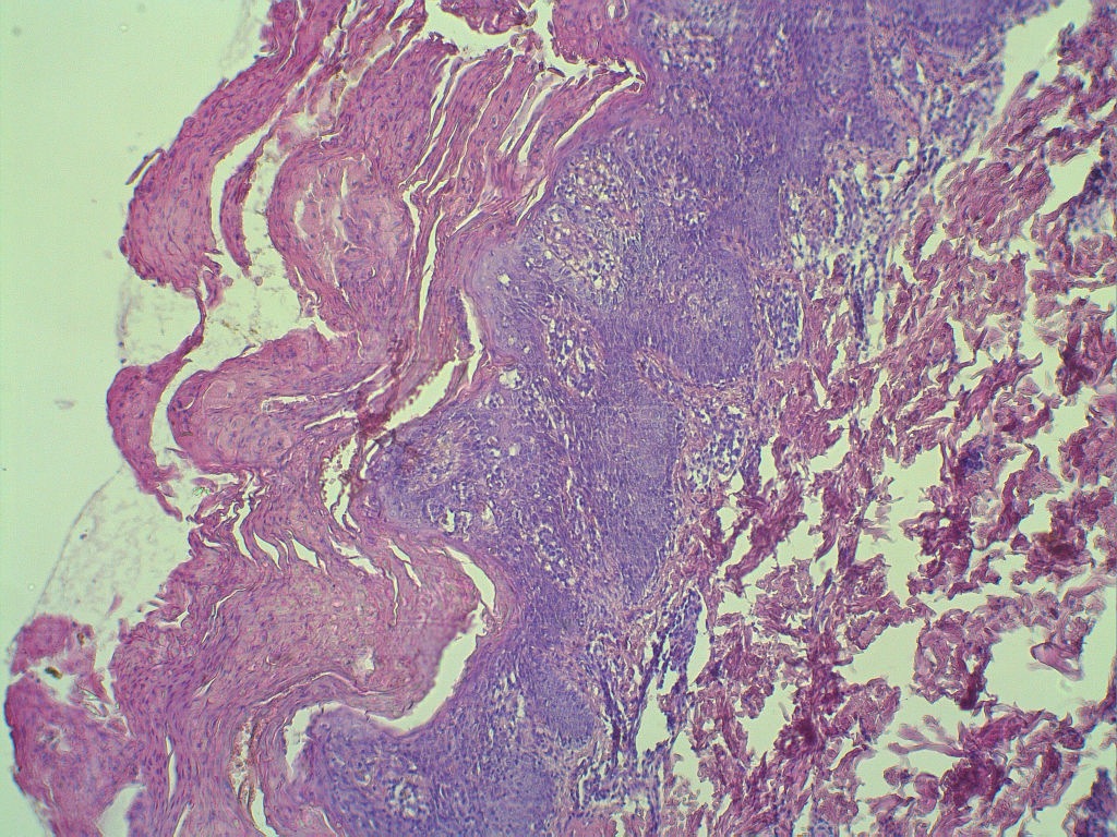 Nº2: Placas eritemato descamativa, lineales, pruriginosas, con 6 meses ...