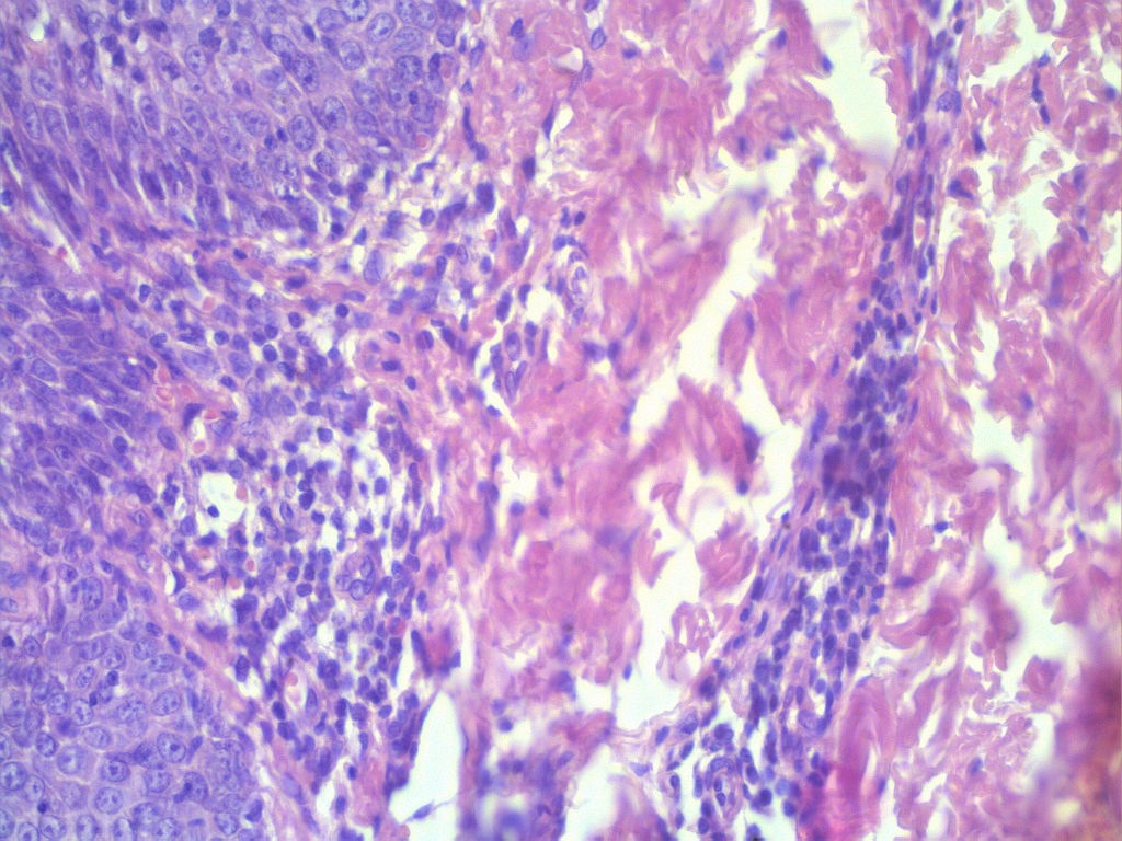 Nº2: Placas eritemato descamativa, lineales, pruriginosas, con 6 meses ...