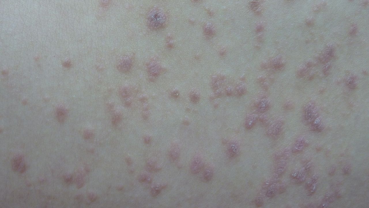 (262) Consulta a un Colega Nº4: Erupción eritemato descamativa, muy ...