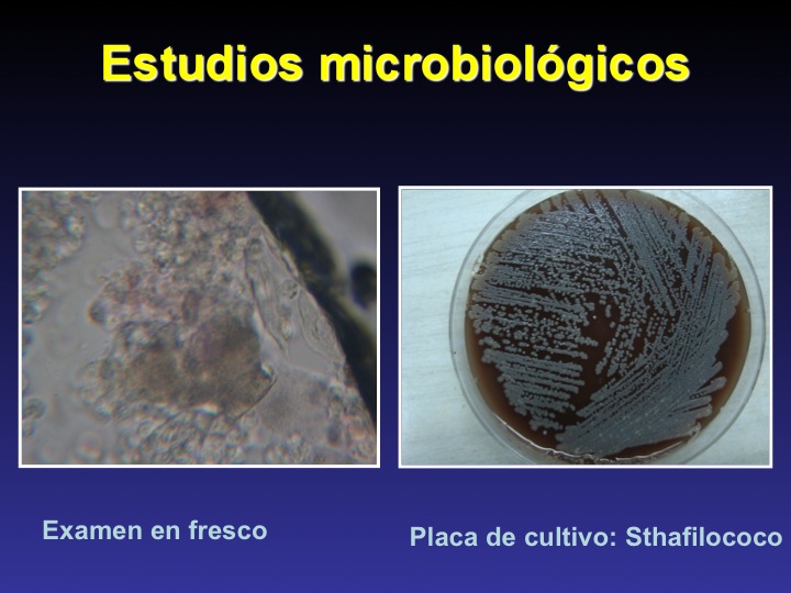 Botriomicosis – PIEL-L Latinoamericana