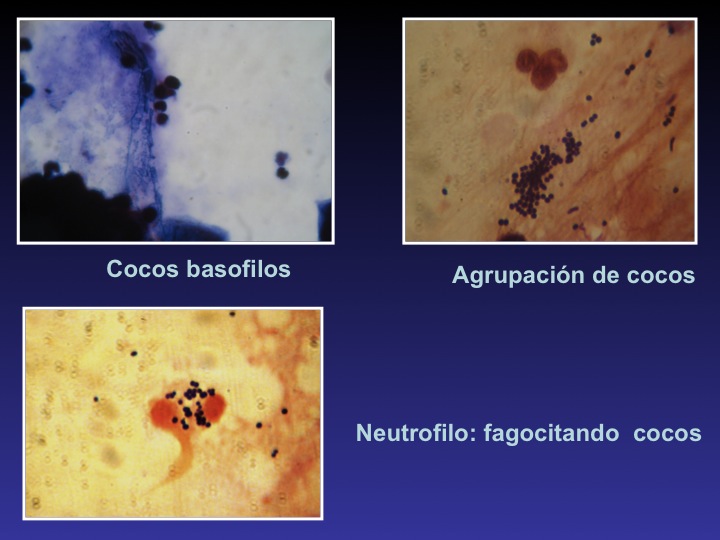 Botriomicosis – PIEL-L Latinoamericana
