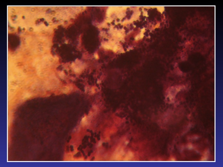 Botriomicosis – PIEL-L Latinoamericana