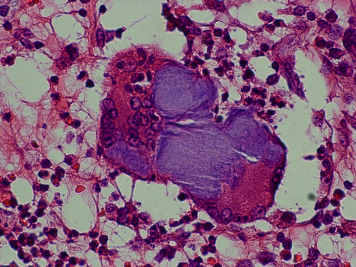 Botriomicosis – PIEL-L Latinoamericana