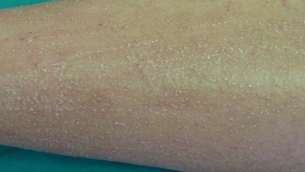 ¿Qué Piensa Usted? Nº4 Edición 265: Piel áspera, seca y con prurito ...