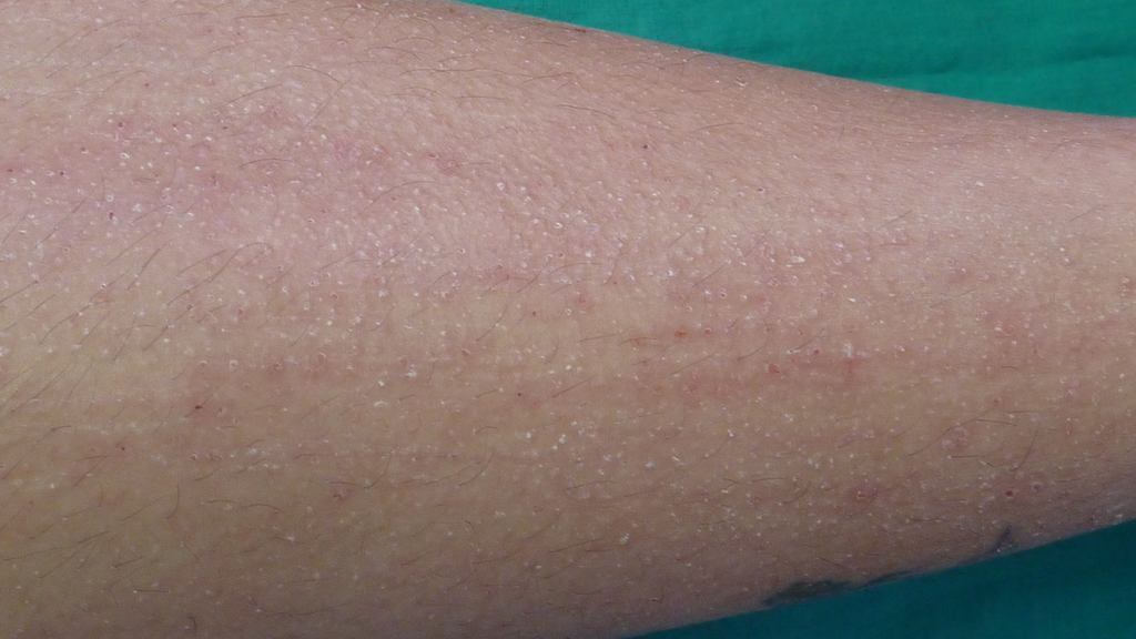 Consulta a un colega N° 4 Edición 265: Prurito con varios años de ...