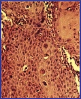 Carcinoma espinocelular en la frente – PIEL-L Latinoamericana