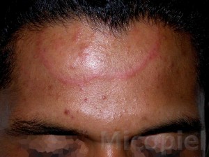 Caso clínico Nº 45. Tinea corporis – PIEL-L Latinoamericana
