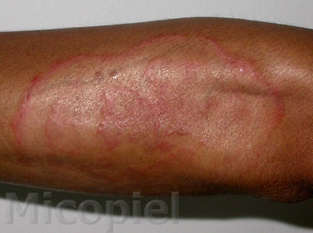 Caso clínico Nº 45. Tinea corporis – PIEL-L Latinoamericana