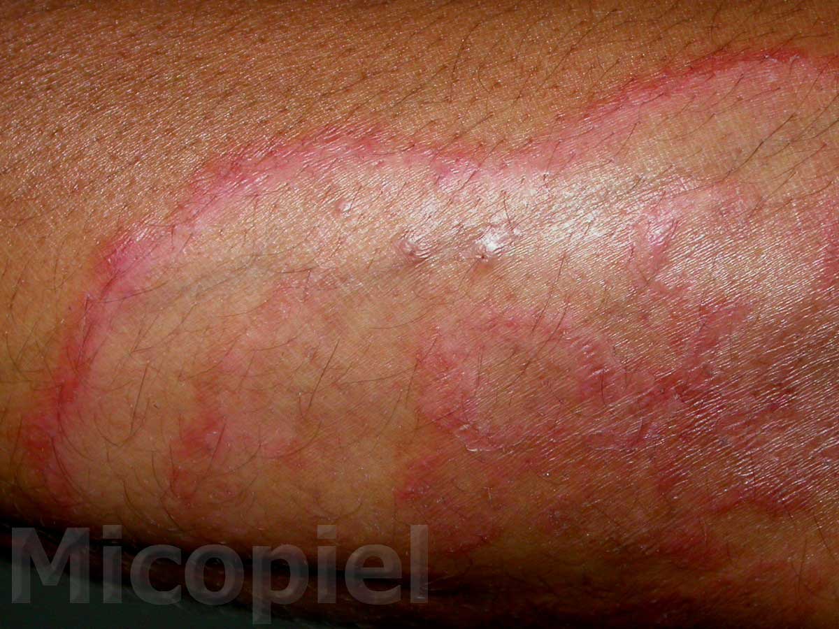 Caso clínico Nº 45. Tinea corporis – PIEL-L Latinoamericana