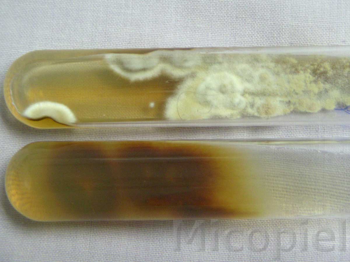 Caso clínico Nº 45. Tinea corporis – PIEL-L Latinoamericana