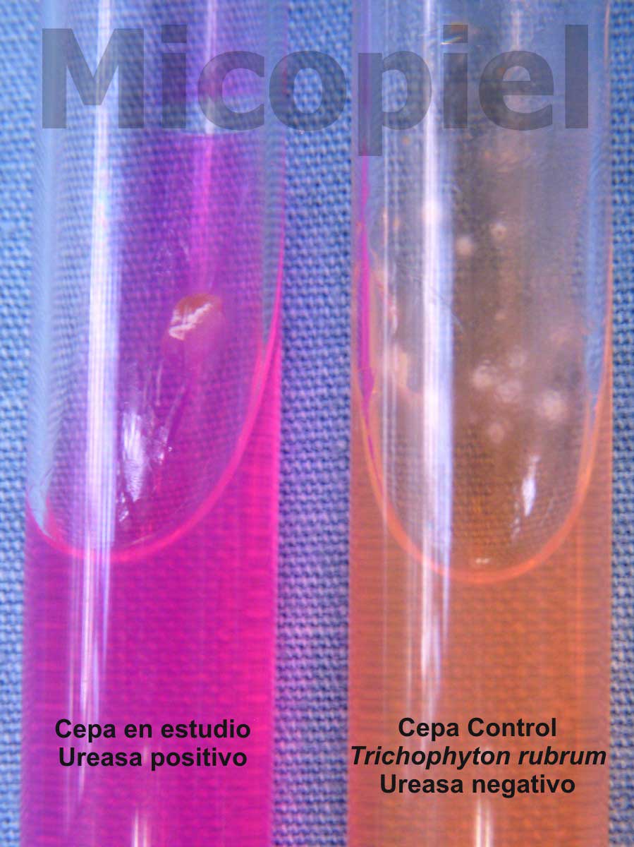 Caso clínico Nº 45. Tinea corporis – PIEL-L Latinoamericana