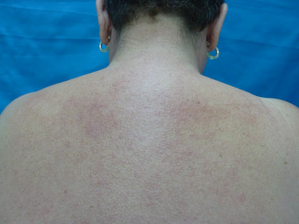 Consulta a un Colega Nº3 Edición 266: placas eritematosas localizadas ...