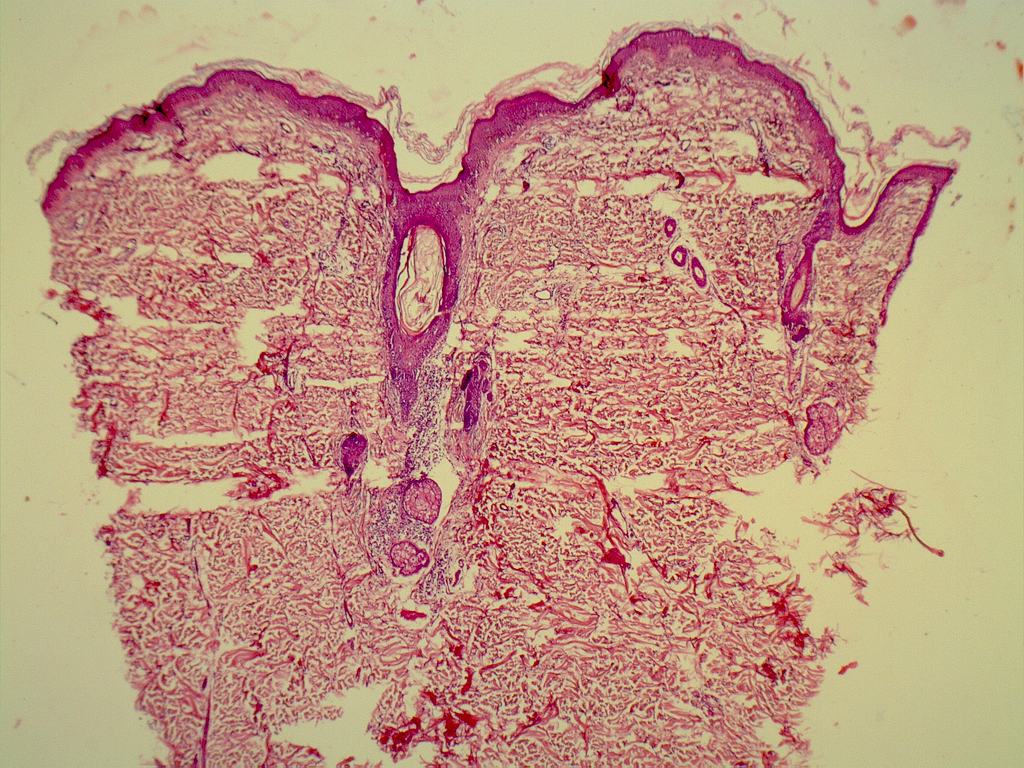 Consulta a un Colega Nº3 Edición 266: placas eritematosas localizadas ...