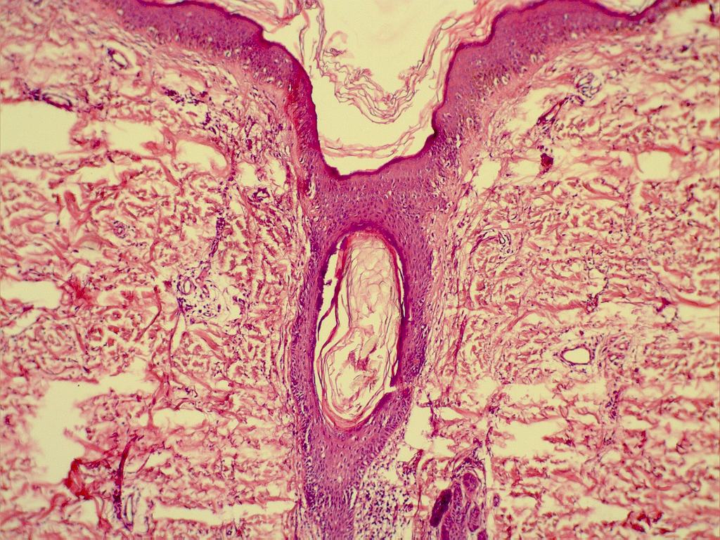 Consulta a un Colega Nº3 Edición 266: placas eritematosas localizadas ...