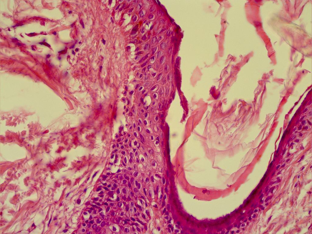Consulta a un Colega Nº3 Edición 266: placas eritematosas localizadas ...