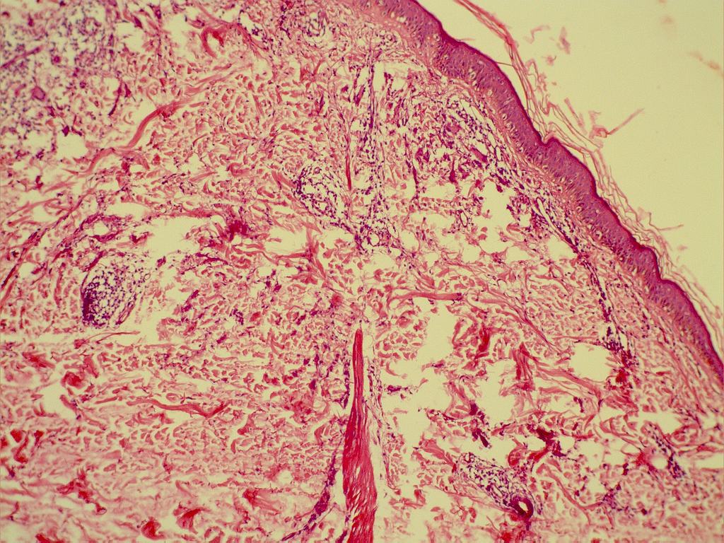 Consulta a un Colega Nº3 Edición 266: placas eritematosas localizadas ...