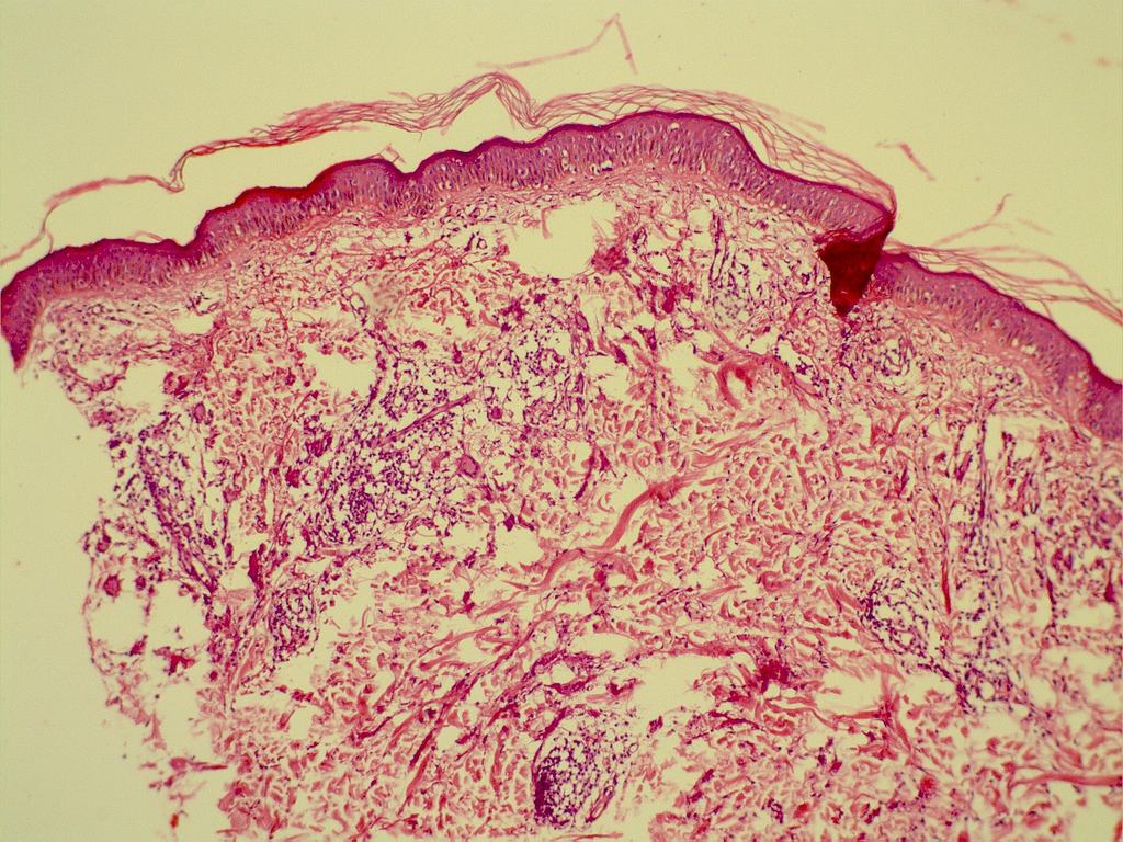 Consulta a un Colega Nº3 Edición 266: placas eritematosas localizadas ...