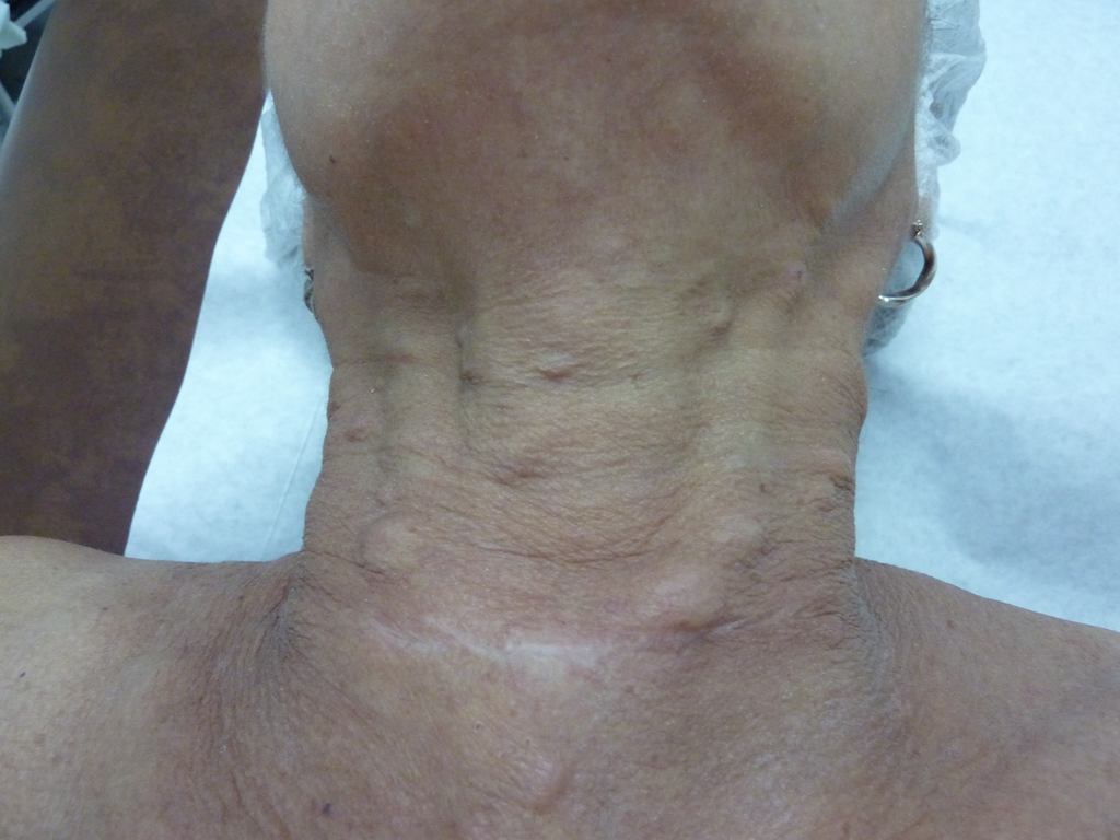 Consulta a un Colega Nº1 Edición 268: Numerosos nódulos sub-cutáneos ...