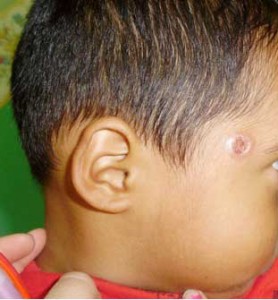 Leishmaniasis, presentaciones atípicas – PIEL-L Latinoamericana