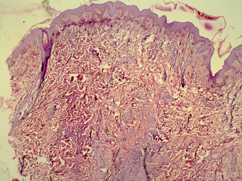 Consulta a un Colega Nº3 Edición 269: Placas y nódulos generalizados y ...