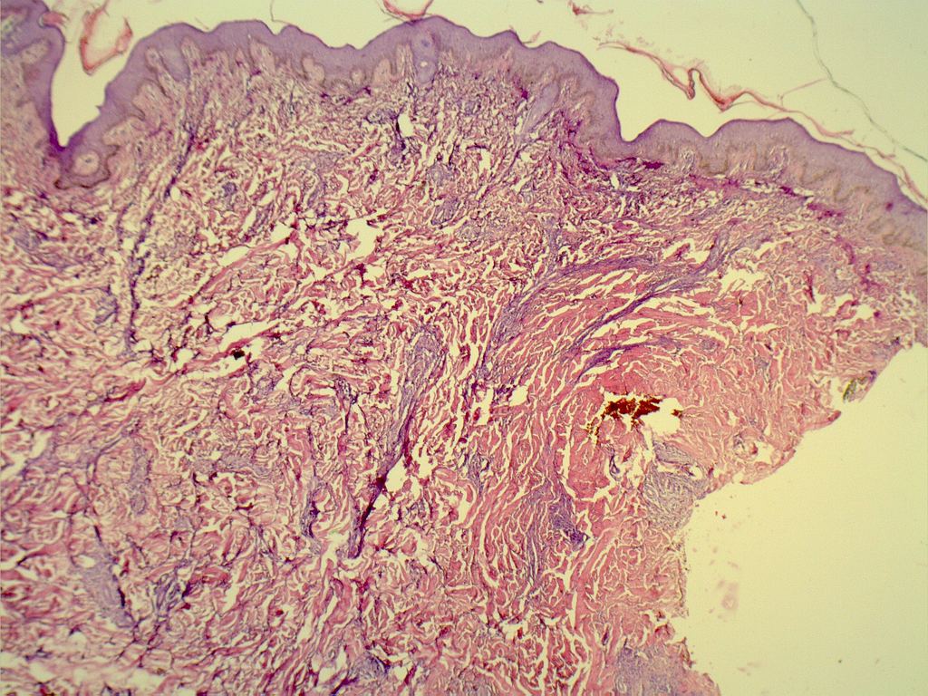 Consulta a un Colega Nº3 Edición 269: Placas y nódulos generalizados y ...